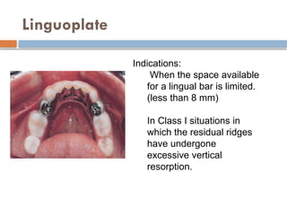 MAJOR connectors.pptx of removable partial denture | PPTX
