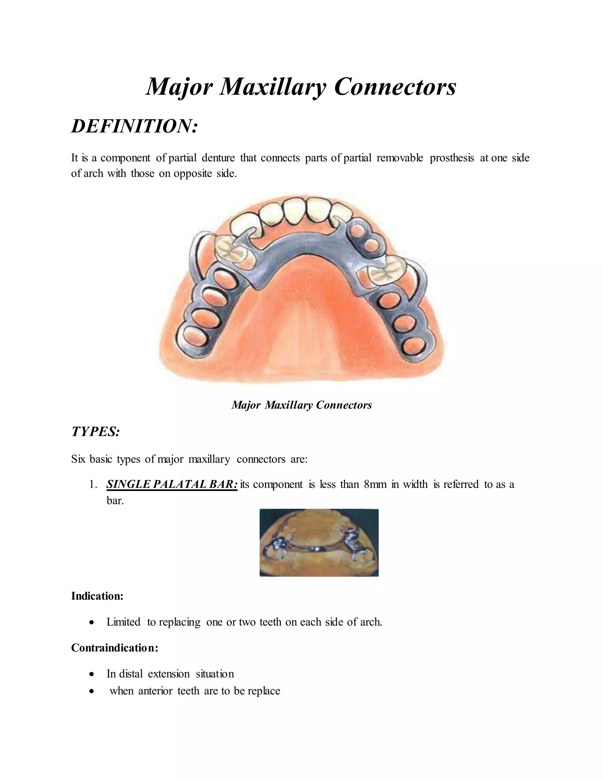 Major Maxillary Connectors | DOCX