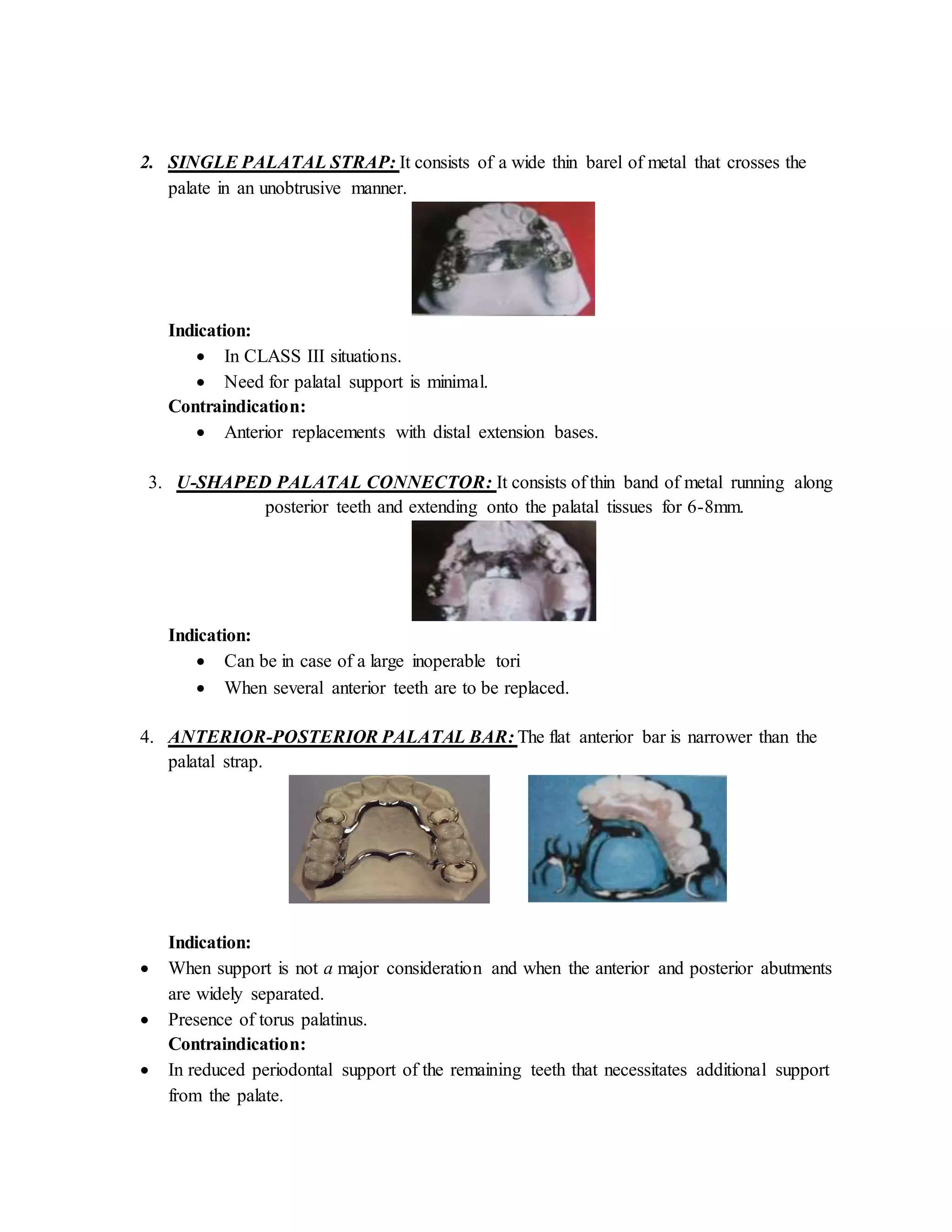 Major Maxillary Connectors | DOCX