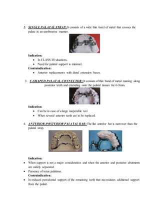 Major Maxillary Connectors | DOCX