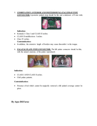 Major Maxillary Connectors | DOCX