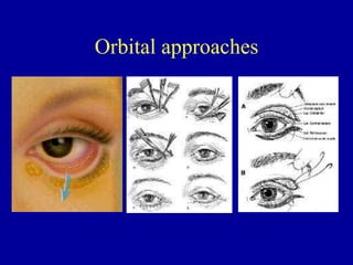 Major Midface Trauma.ppt