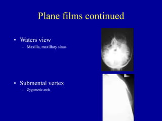 Major Midface Trauma.ppt