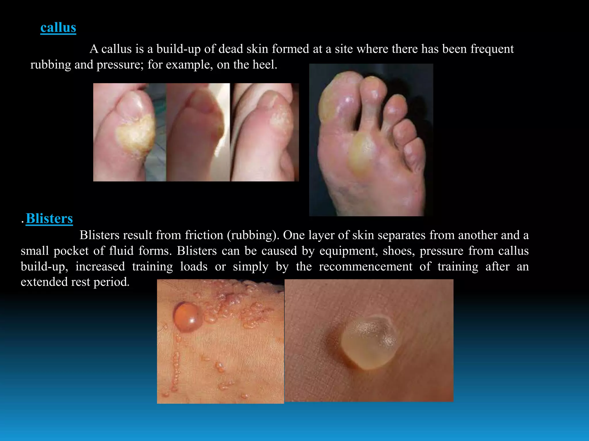 Major sports injuries and classification of injuries | PPTX