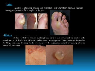 Major sports injuries and classification of injuries | PPTX