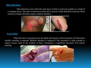 Skin Avulsion In Sports