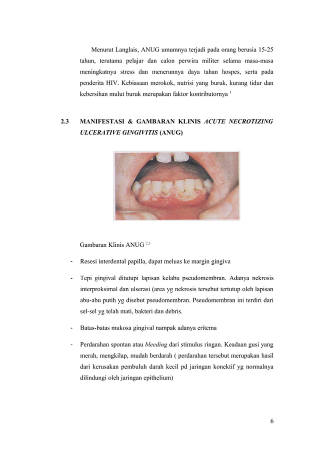 Acute Necrotizing Ulceration Ginggivitis | DOC
