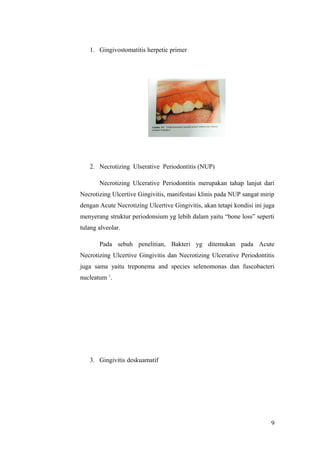 Acute Necrotizing Ulceration Ginggivitis | DOC