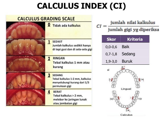 Dental calculus classification - tapekiza