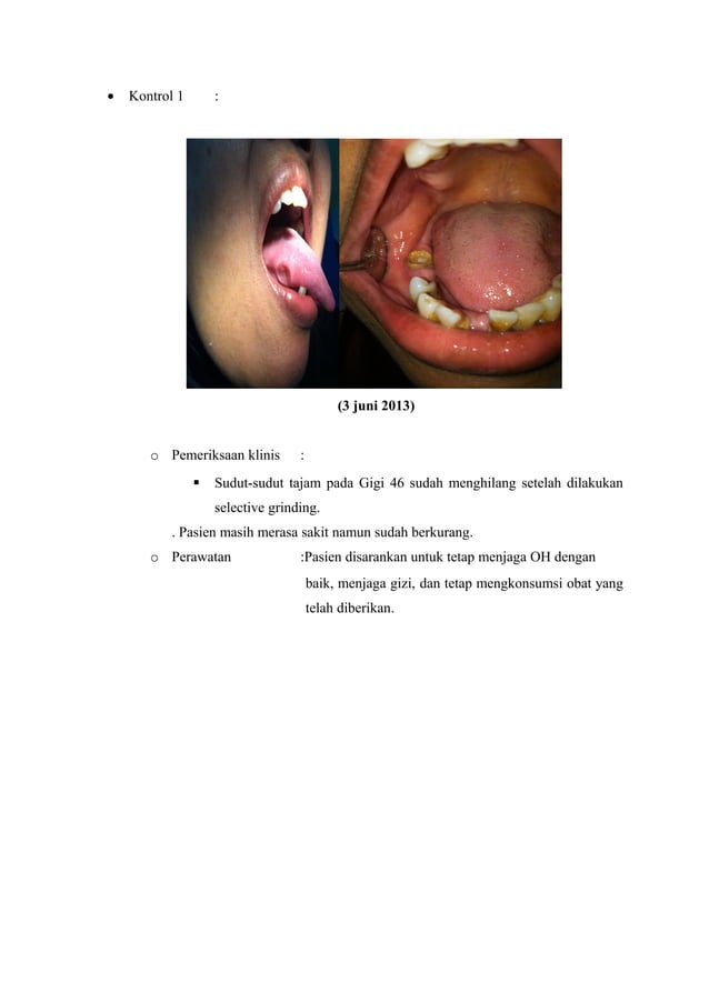 Traumatic ulcer and Fordcye's spot clinical case study (indonesian text ...