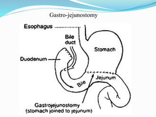 Mal absoprtion syndrome | PDF