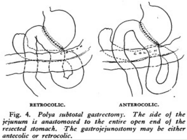 Malabsorbtion vs Restriction Post RNY Bypass