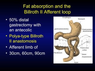 Polya Gastrectomy