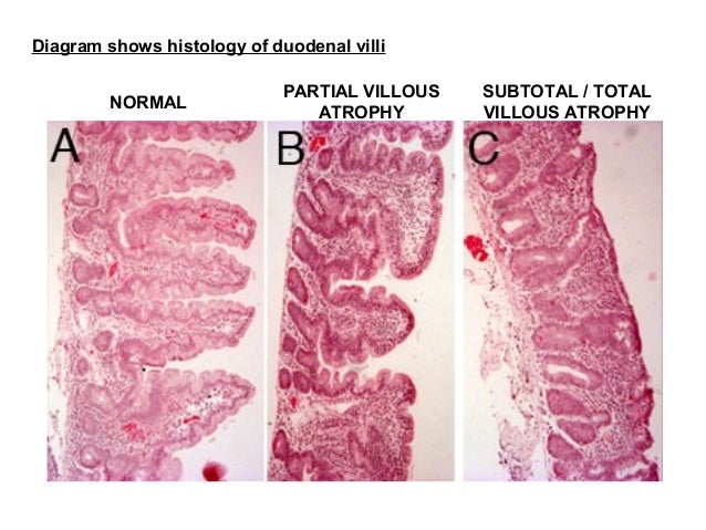 Malabsorption in tropical sprue & coeliac disease