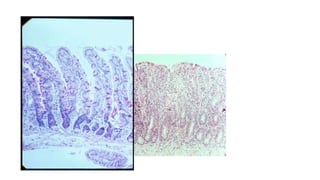 Malabsorption pediatric | PPTX