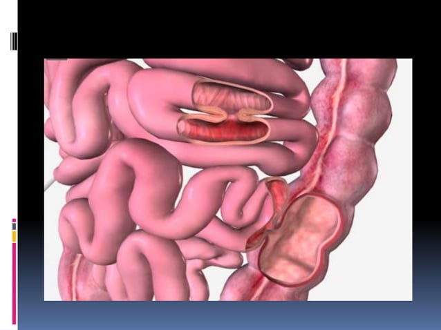 Malabsorption syndrome | PPT