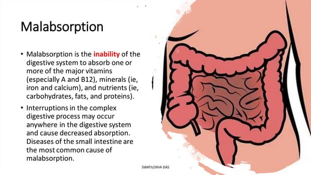 Malabsorption syndrome | PPT