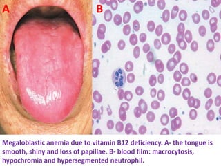approach to Malabsorption Syndrome .pptx