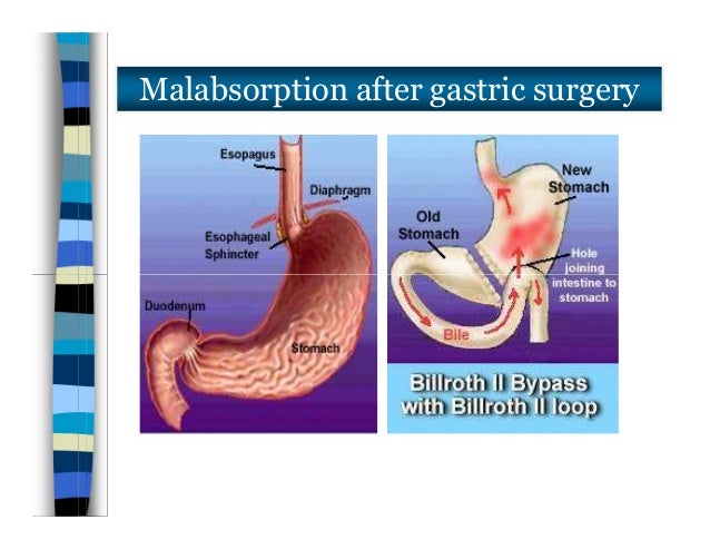 Malabsorption syndromes