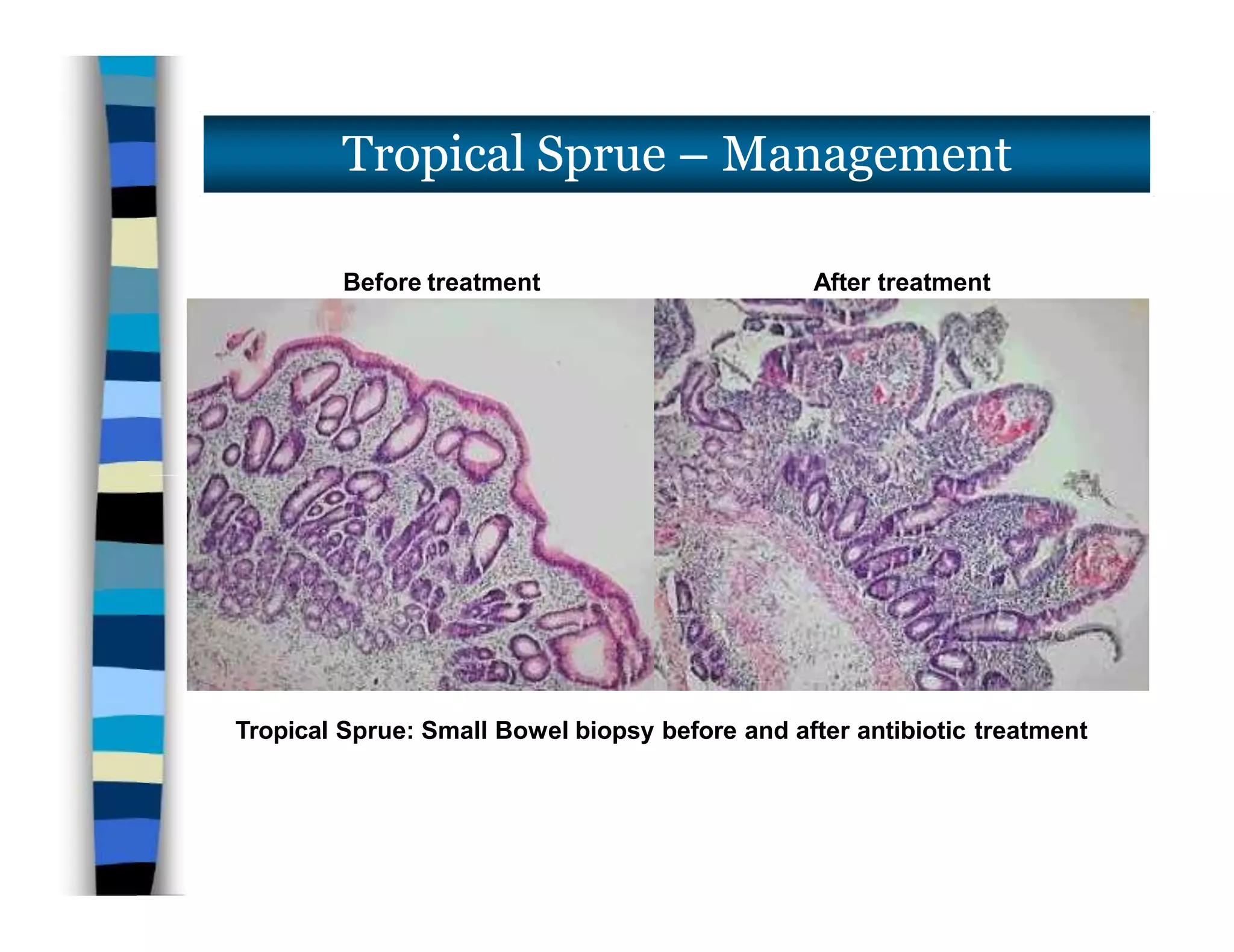 malabsorptionsyndromes-3.pptx