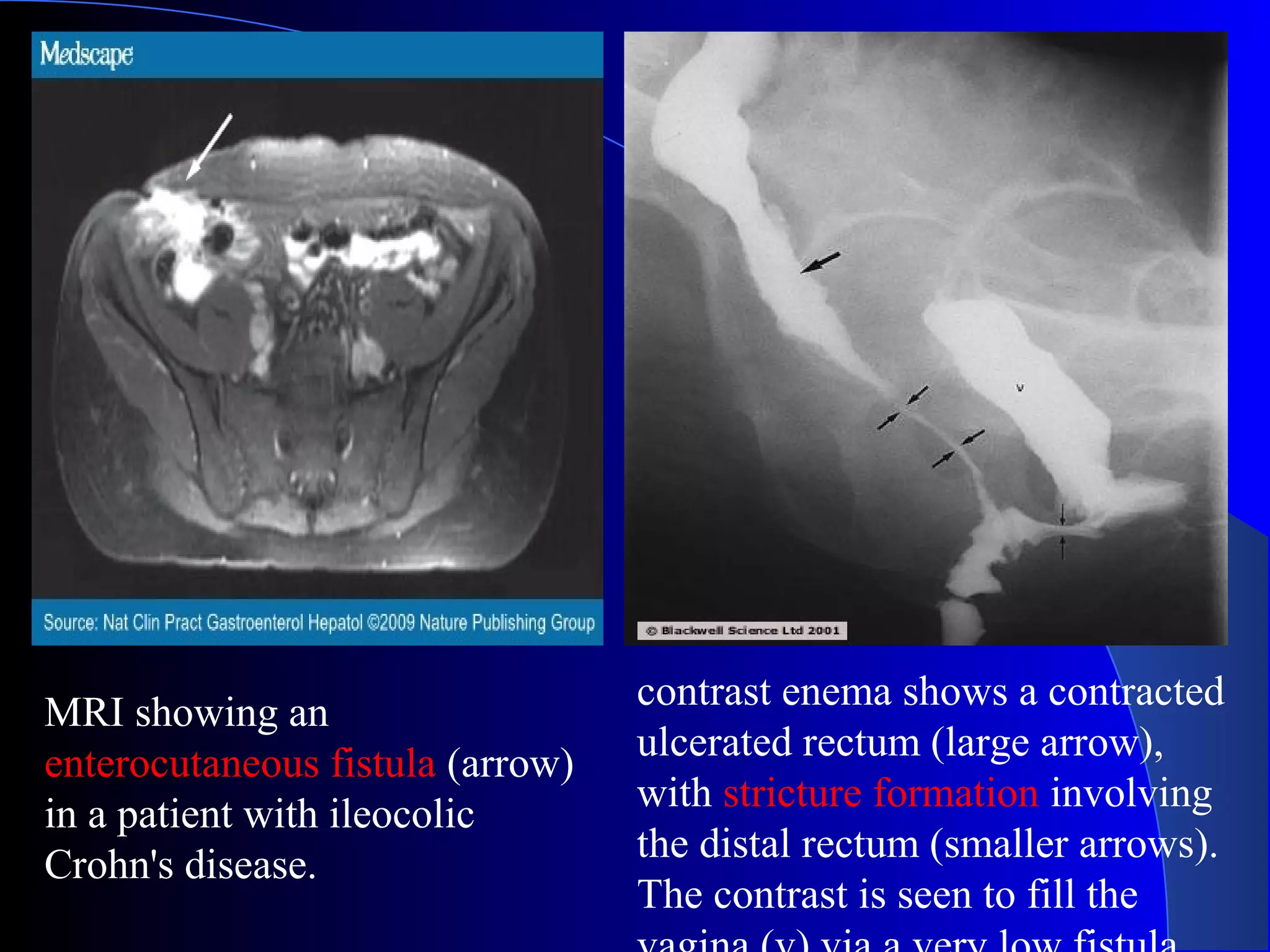 Malabsorptive disorders final presentation | PPT