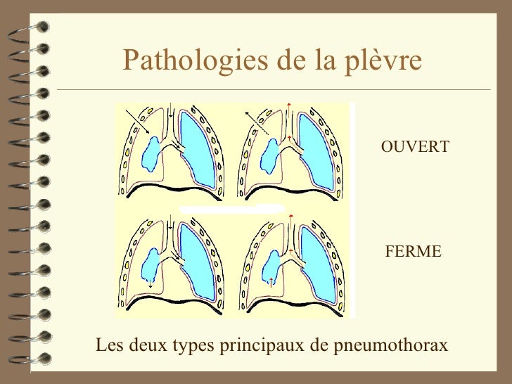 Inflammation De La Plevre – Qu’Est Ce Qu’Une Pleurésie – MGNAR