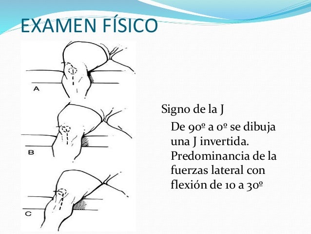 Mal alineamiento patelofemoral