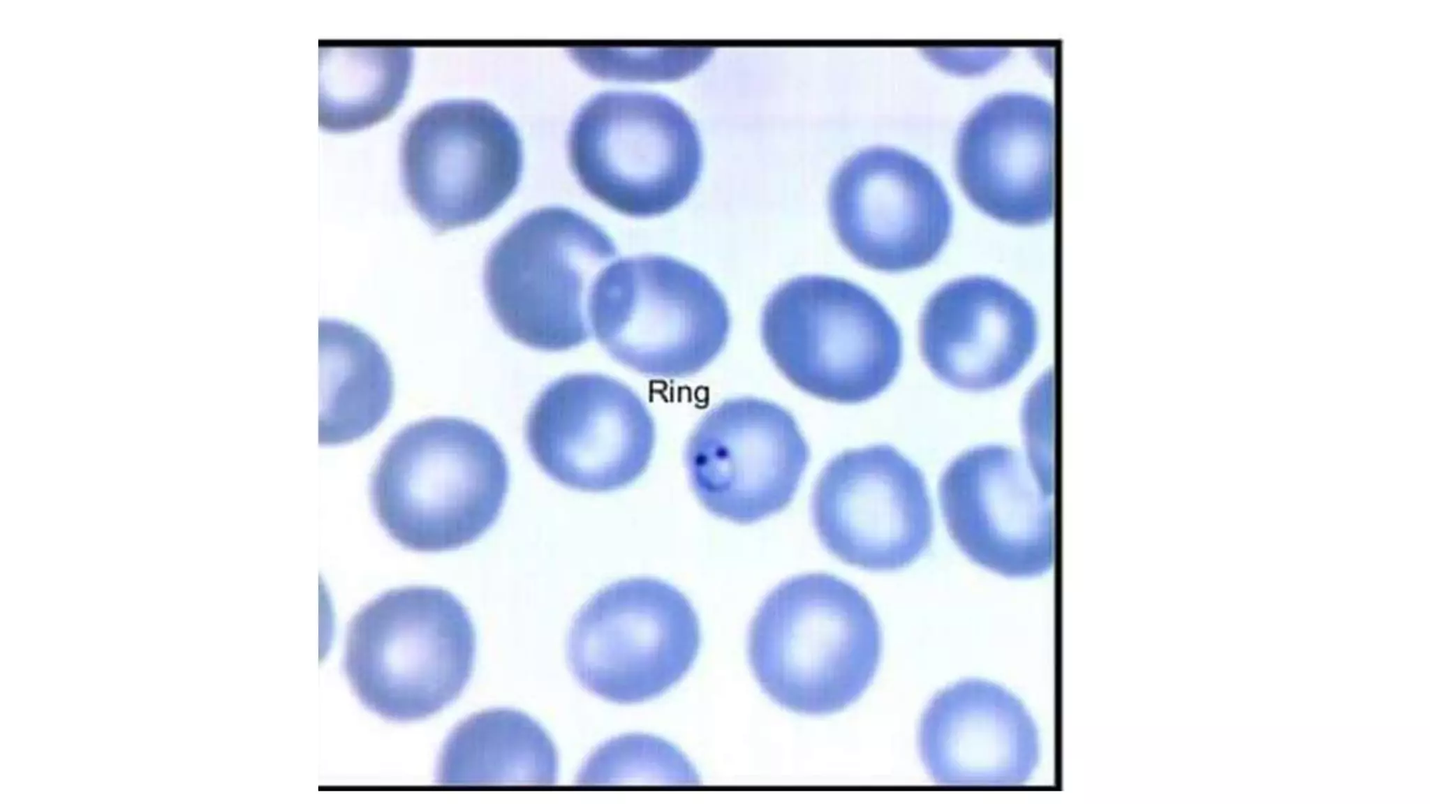 Malaria -causes| types| management -medical information | PPTX
