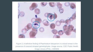 Malaria - Clinical Features and Diagnosis.pdf