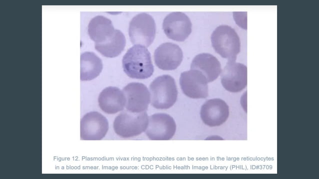 Malaria - Clinical Features and Diagnosis.pdf