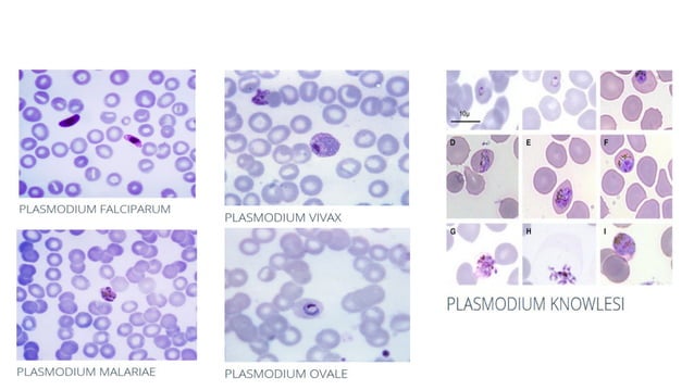 The Epidemiology of Malaria- causes, types of malaria | PPTX