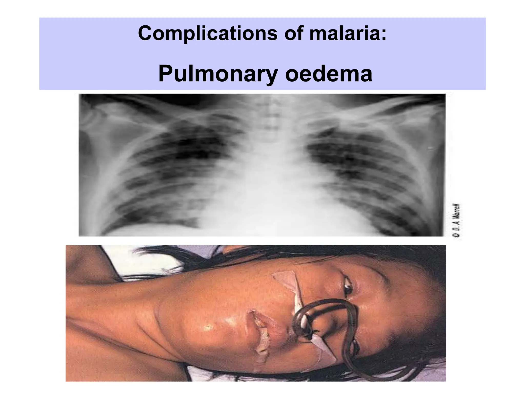 Malaria 2019.pptx plamodium ovsle, falciprum, vivax, malarea | PPTX