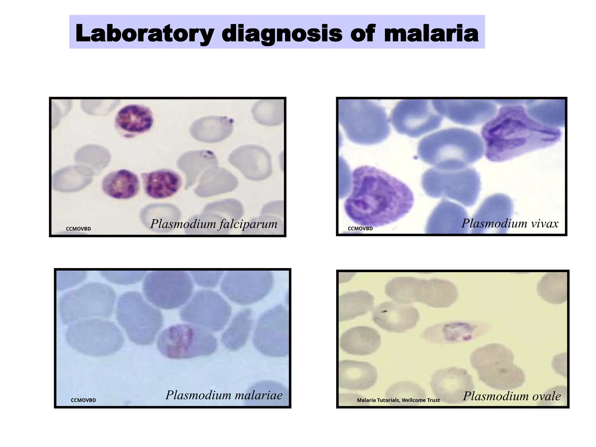 Malaria its causes and effects in human and effect | PPTX