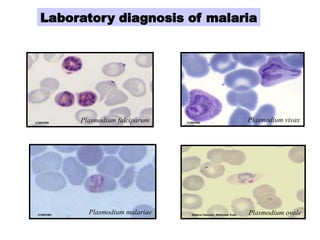 Malaria its causes and effects in human and effect | PPTX