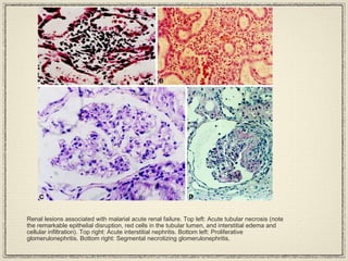 Malaria arf | PPT