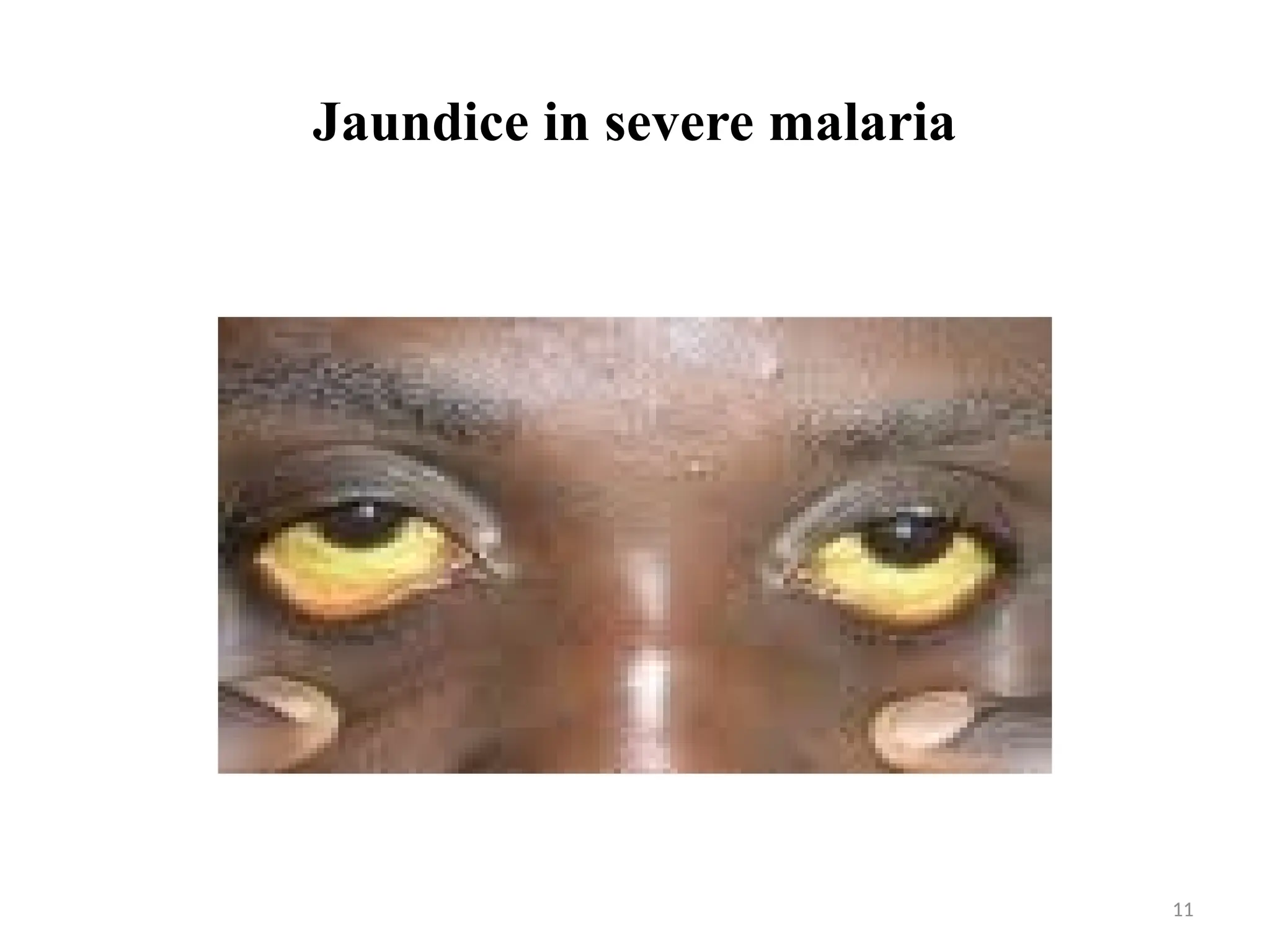 Malaria pediatric children Lecture.pptx