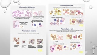 CASE PRESENTATION OF MALARIA | PPTX