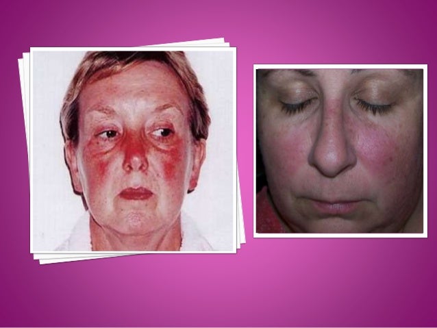 Lupus Malar Rash Characteristics