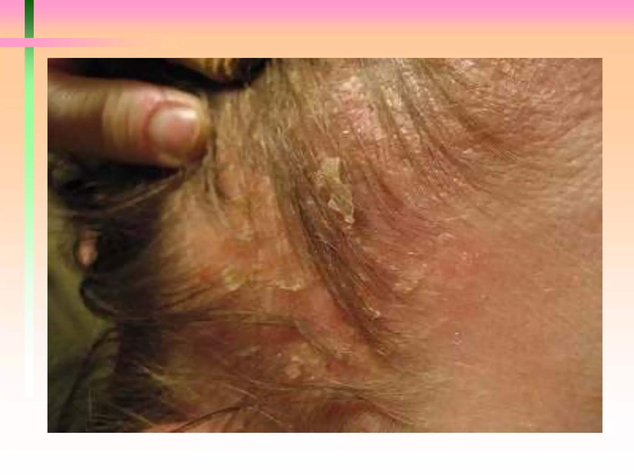 Malassezia infection | PPTX