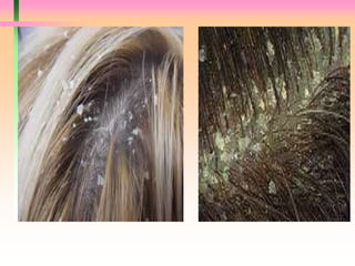 Malassezia infection | PPTX