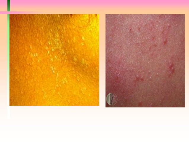 Malassezia infection | PPTX | Skin and Dermatology | Diseases and ...
