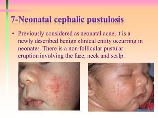 Neonatal Cephalic Pustulosis