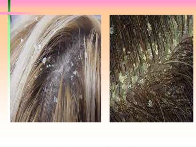 Malassezia infection