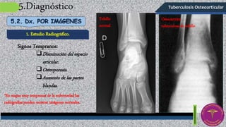 Tuberculosis Osteoarticular | PPTX