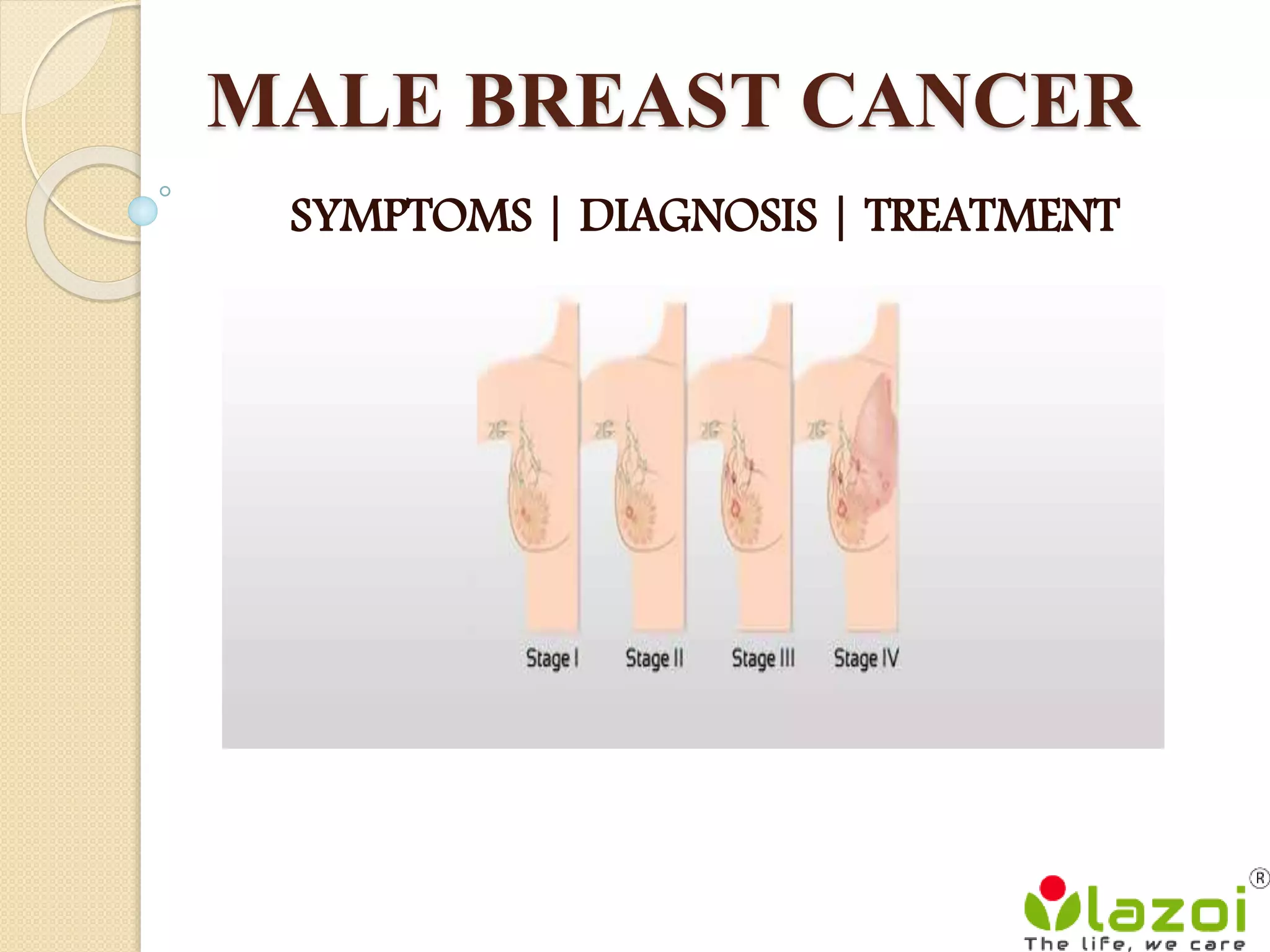 Male Breast Cancer : Symptoms, diagnosis and treatment | PPTX