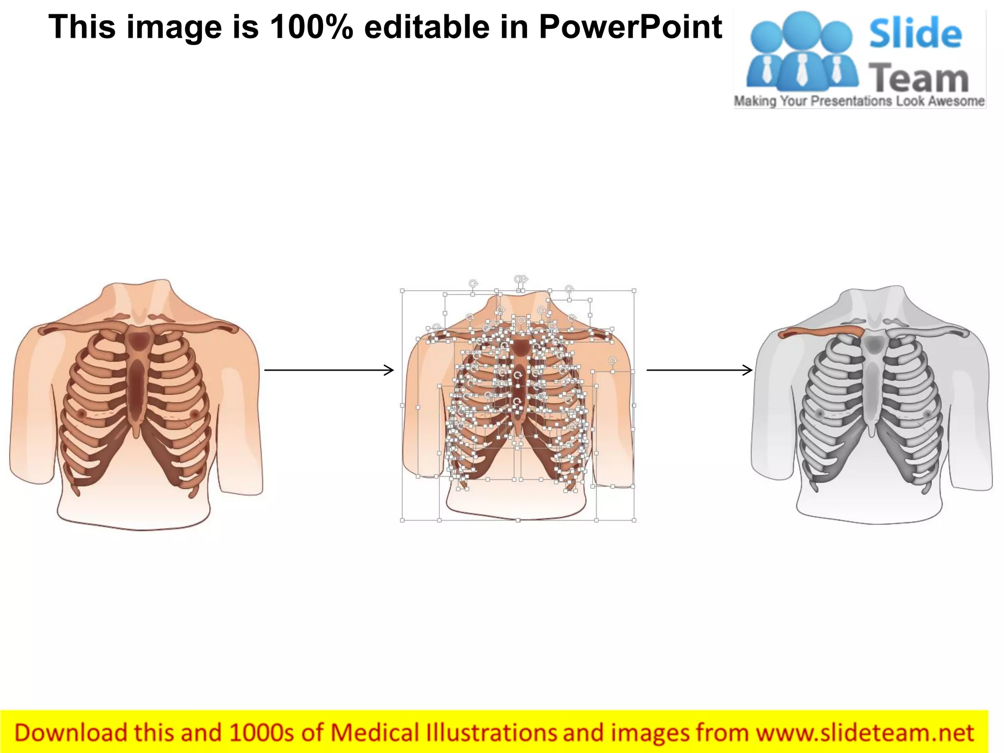 Male chest wall – anterior view medical images for power point | PDF