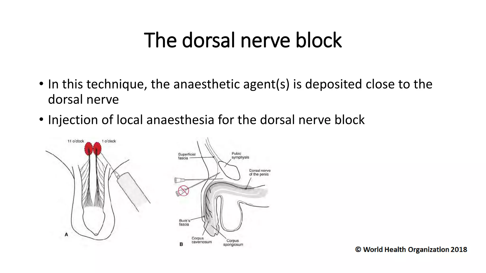 Male Circumcision under Local Anaesthesia by Dr Grothuesmann & Sr Winie ...