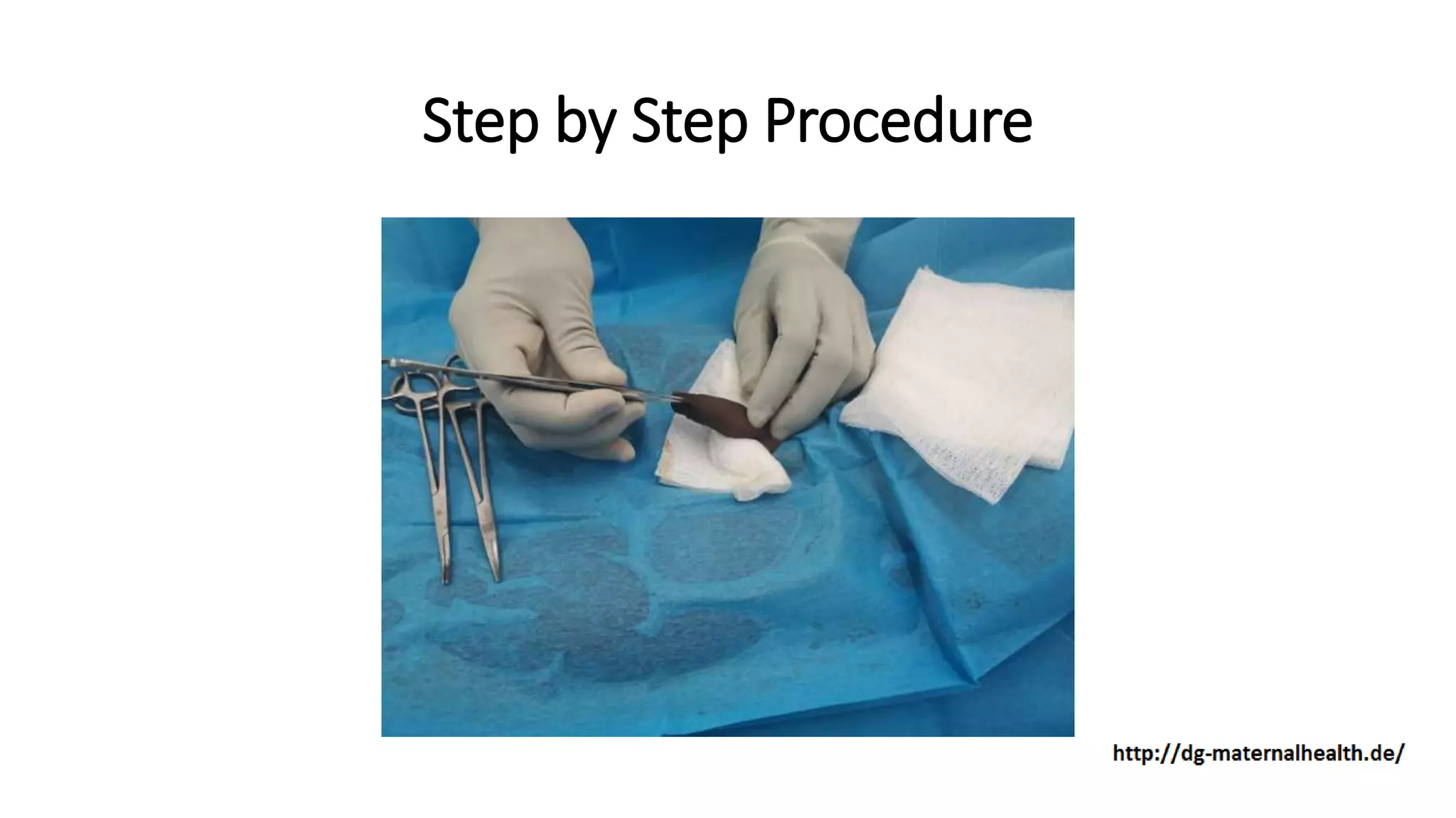 Male Circumcision under Local Anaesthesia by Dr Grothuesmann & Sr Winie | PPTX