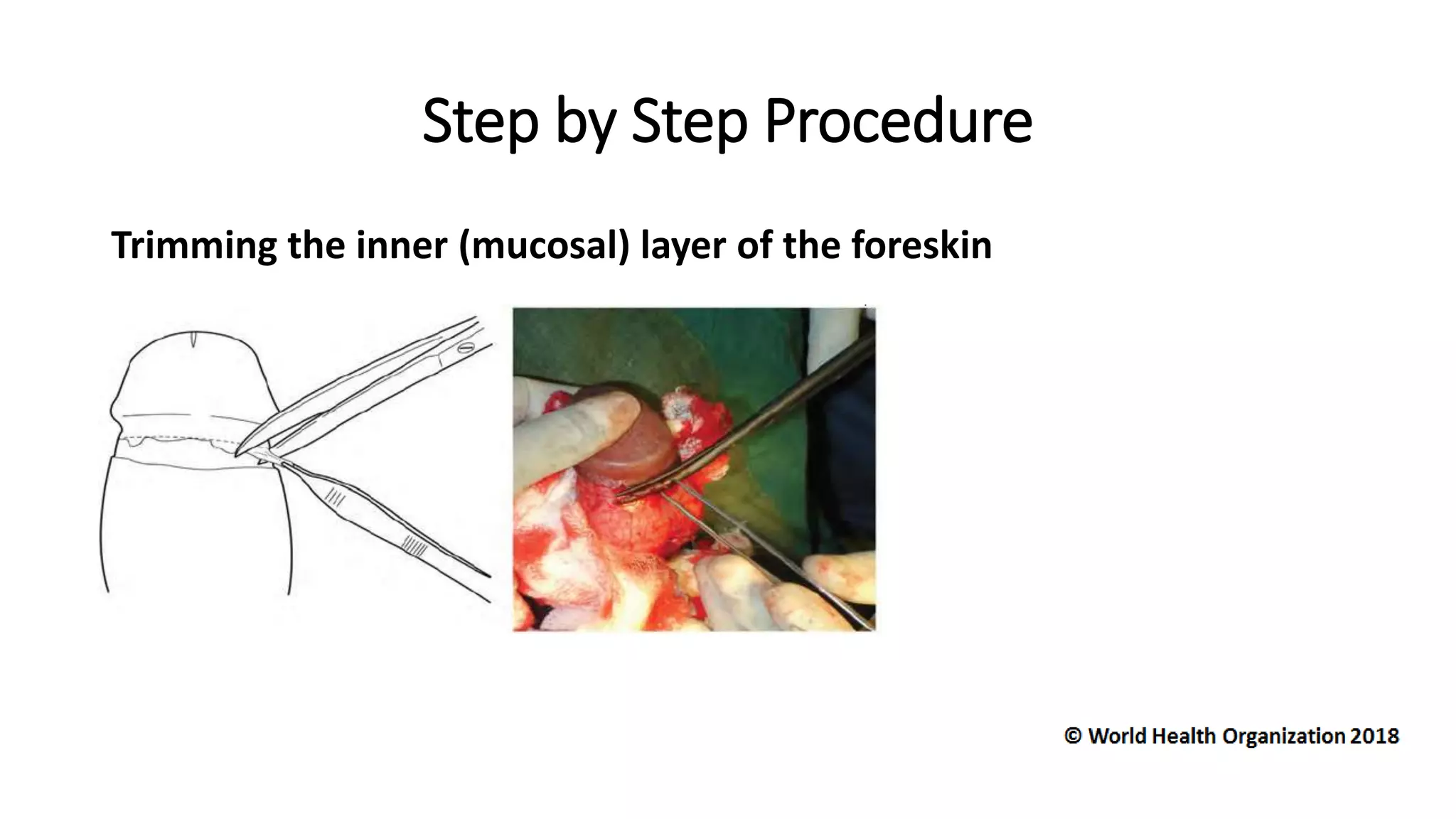Male Circumcision under Local Anaesthesia by Dr Grothuesmann & Sr Winie ...