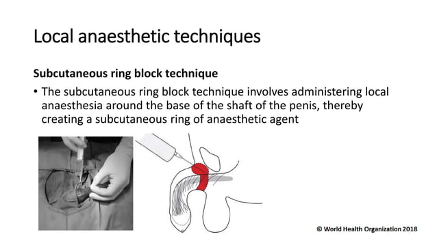 Male Circumcision under Local Anaesthesia by Dr Grothuesmann & Sr Winie ...